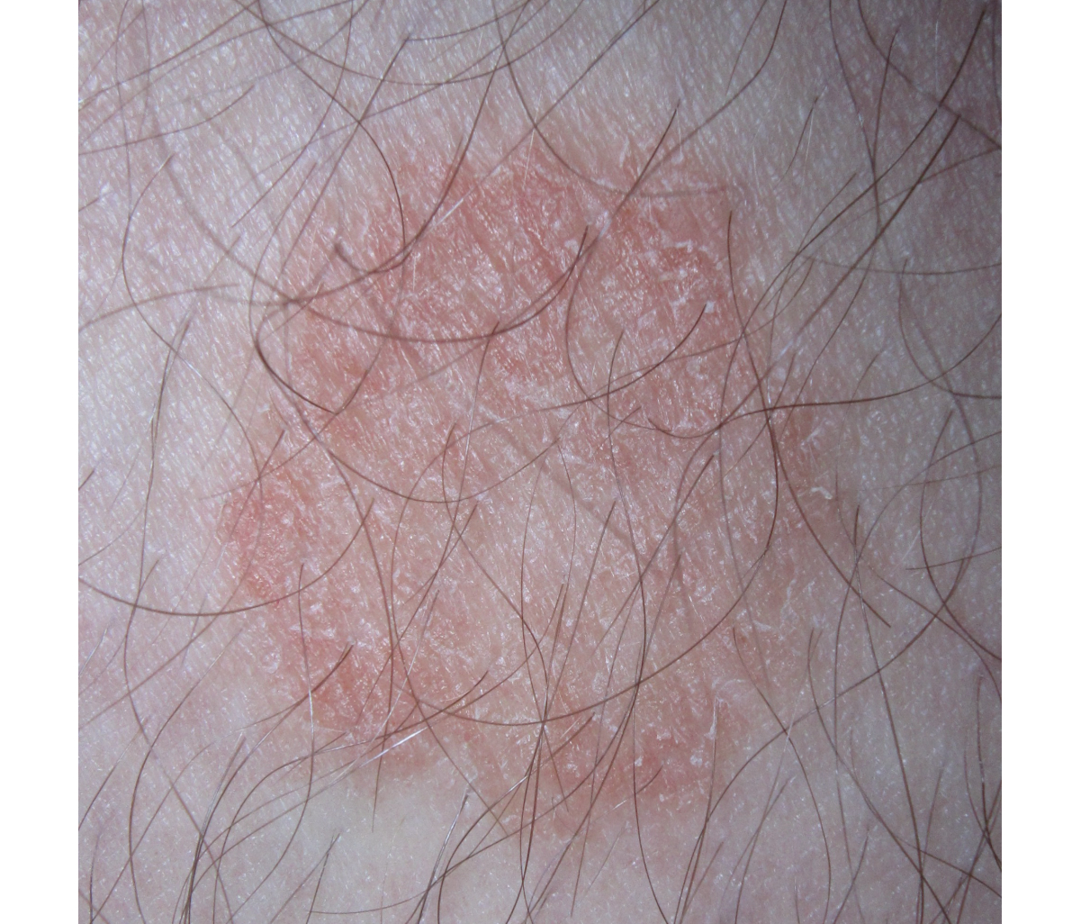 Ringworm Tinea Dermatophytosis Causes Symptoms Signs Treatment Faq